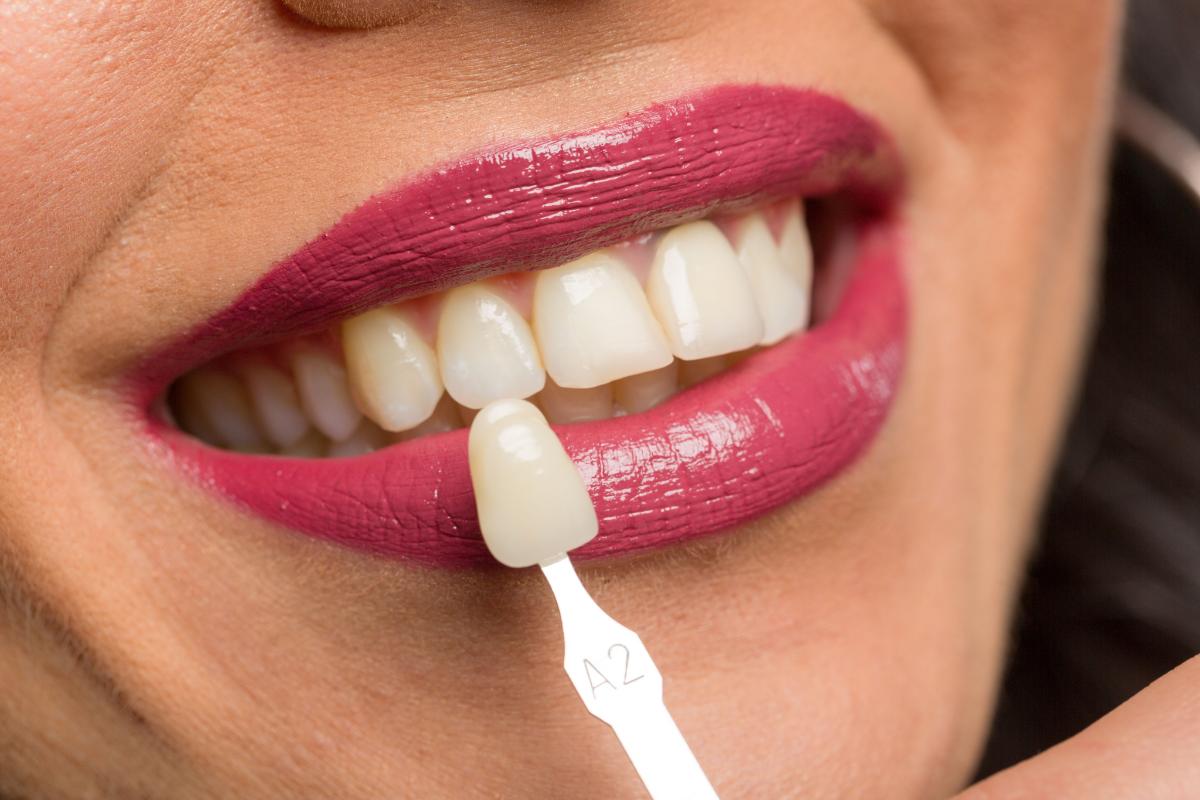 5 Benefits Of Dental Veneers Cosmetic Dental Services Atascocita Tx